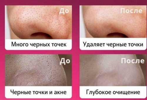 Маска от прыщей и черных точек