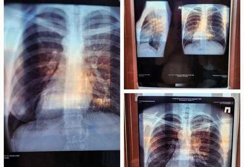 Рентгеновские снимки легкого
