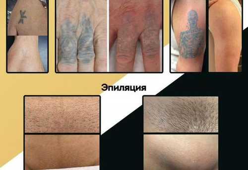 Диодный лазерный аппарат удаление татуировок