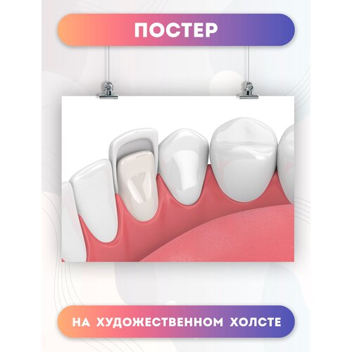 Постер на холсте Стоматология Виниры (4) 60х80 см
